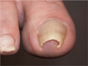 Sore toenails - Zest Podiatry & Physio